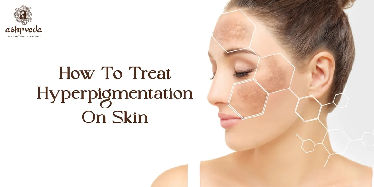 How To Treat Hyperpigmentation On Skin Naturally | Ashpveda