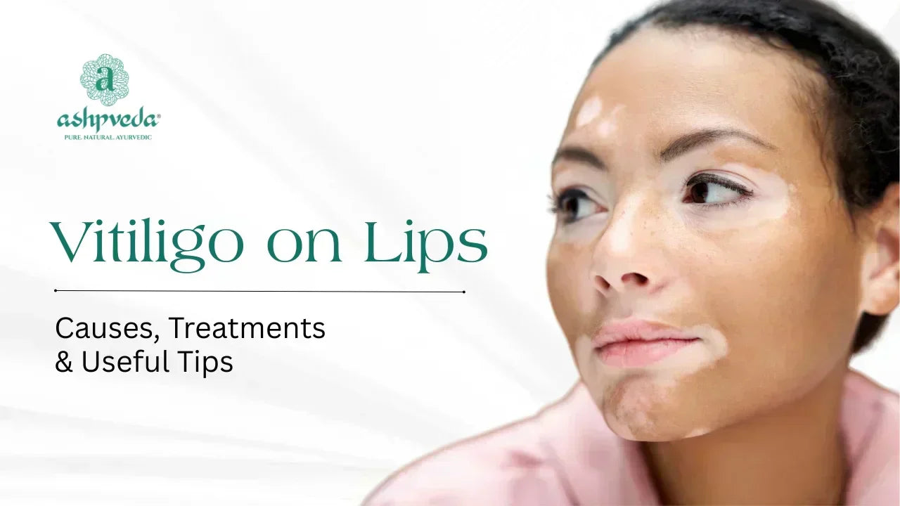 Vitiligo on Lips: Causes, Symptoms and Treatment Options